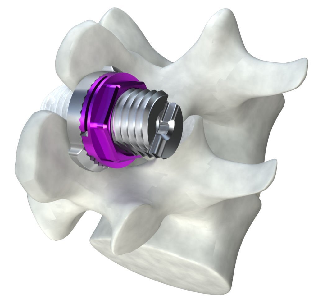 The Minuteman® Procedure in Palm Beach County – Certified Spine & Pain Care