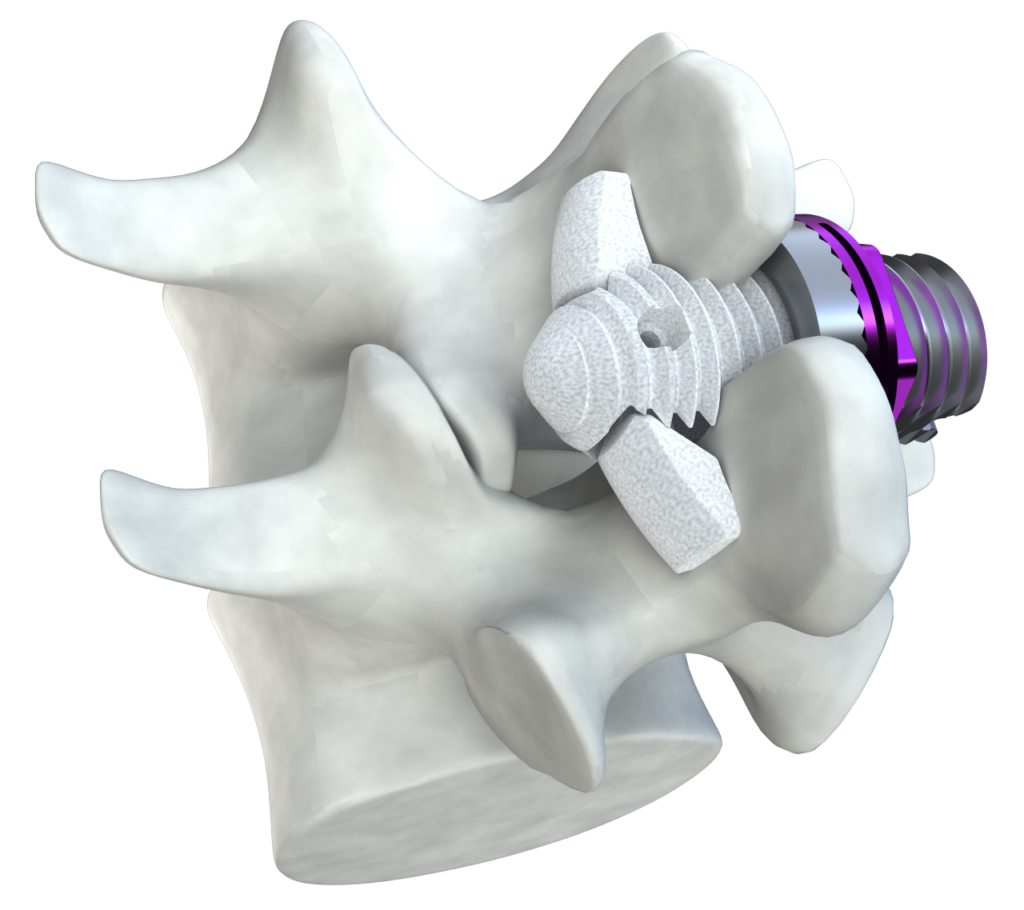 The Minuteman® Procedure in Palm Beach County – Certified Spine & Pain Care